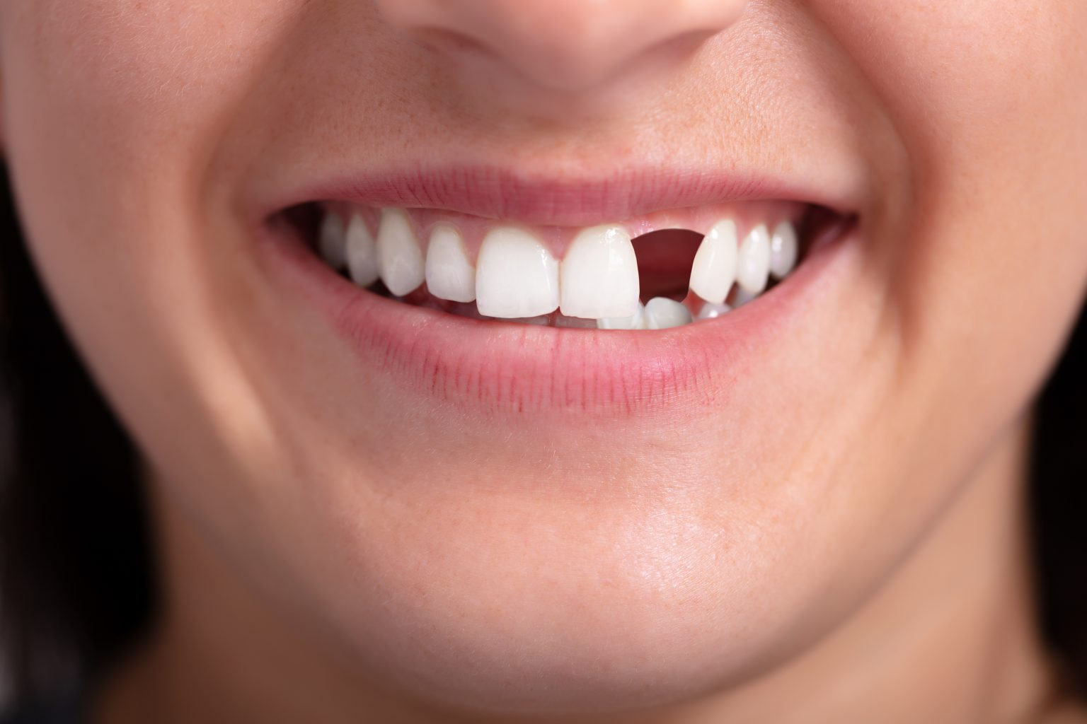 Why You Need to Replace that Lost Tooth | Smith Family Dentistry