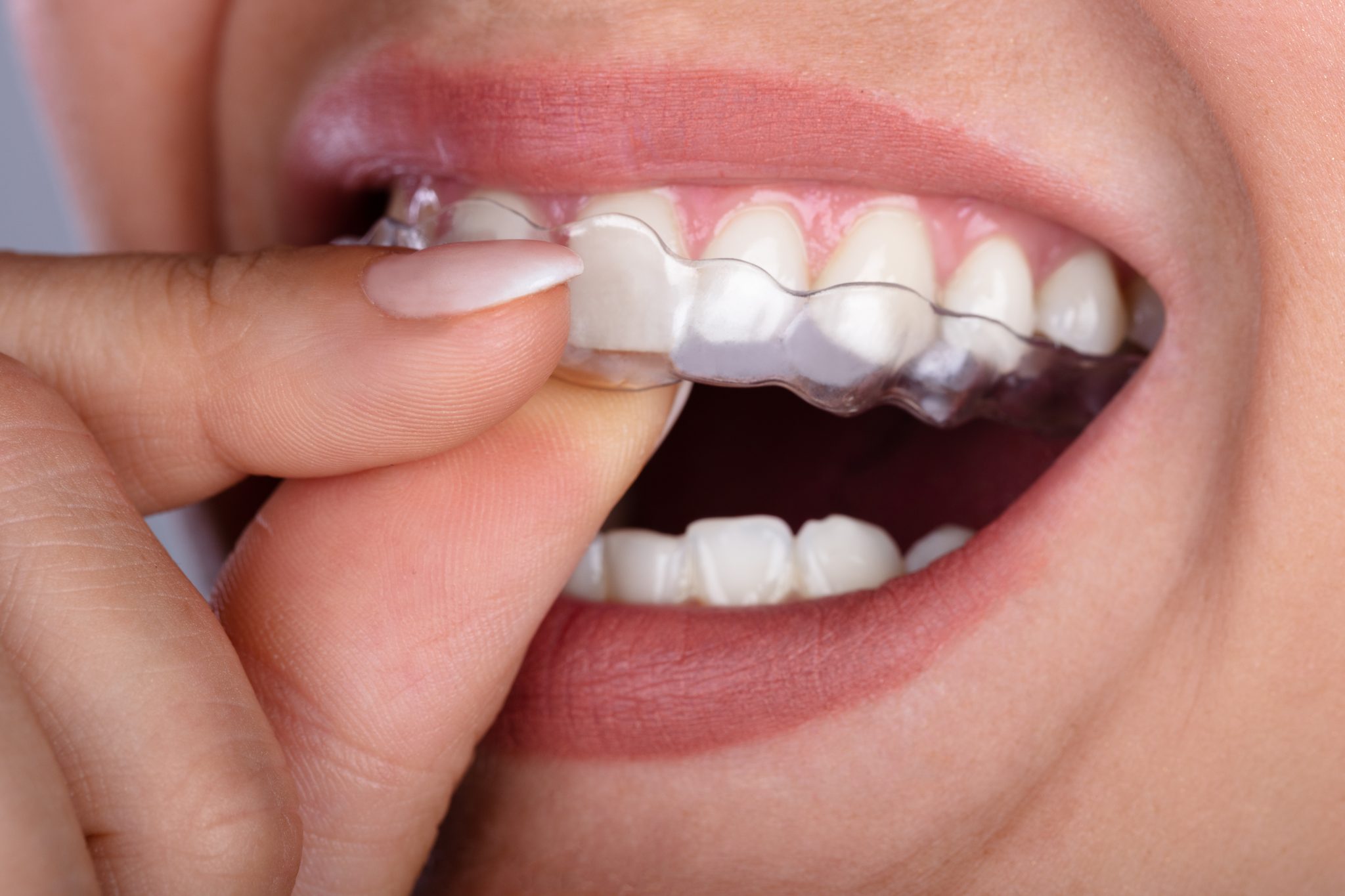 Greenville Dentist Explains How Bruxism Damages Your Smile | Smith ...