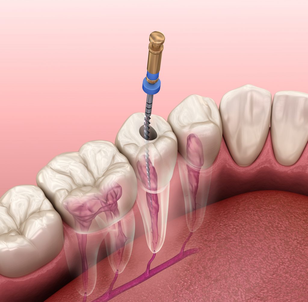 Greenville Dentist Treats Infected Teeth With A Root Canal