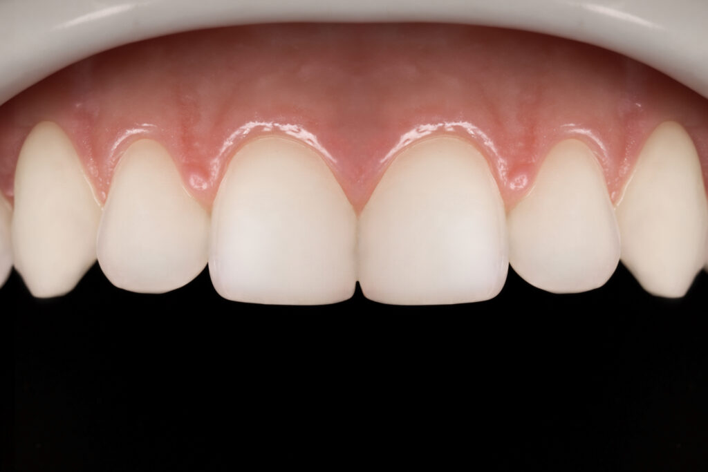 Correcting Smile Issues With Bonding | Smith Family Dentistry